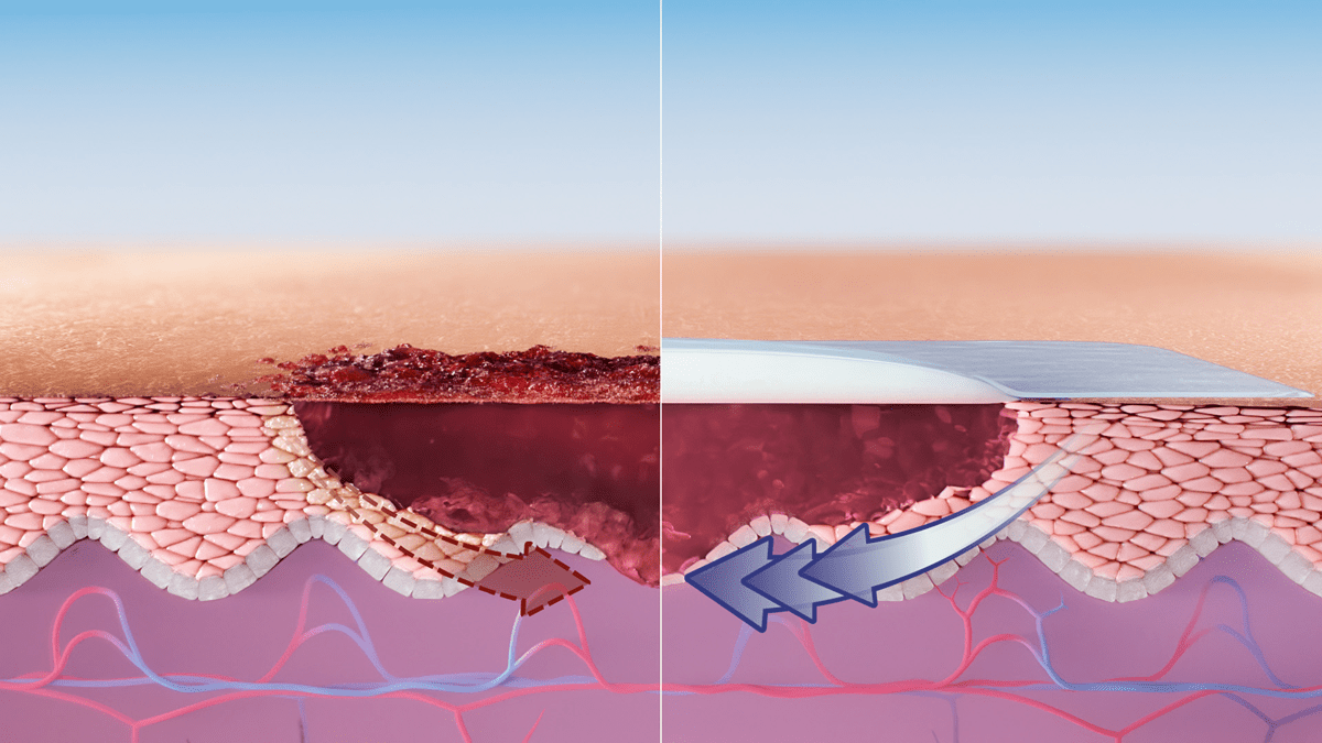 Innovative Wound Care: Rethinking Plasters and Wound Healing | Beiersdorf